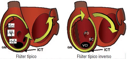 Notas de Medicina Familiar: ECG: Flutter auricular