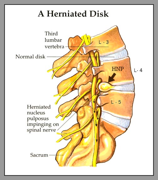 KARYA - KARYAKU: Sembuh Dari HNP