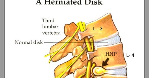 KARYA - KARYAKU: Sembuh Dari HNP
