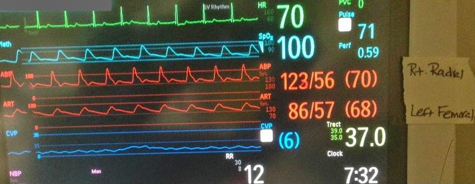PediCardiology Quiz Answers: Quiz #33: Arterial line traces - Answer