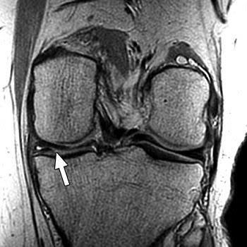 Lesión de Meniscos - Resonancia Magnética