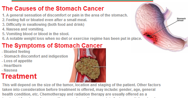 Stage 4 Gastric Stomach Cancer
