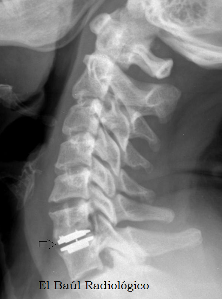 El Baúl Radiológico: ARTROPLASTIA INTERSOMÁTICA CERVICAL: ARTEFACTOS ...