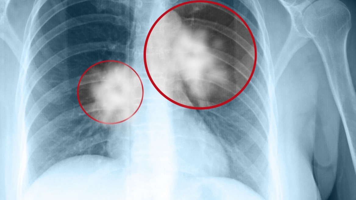 Foto Penderita Kanker Paru-Paru, Beginilah Kondisi Mereka | LIAT AJA