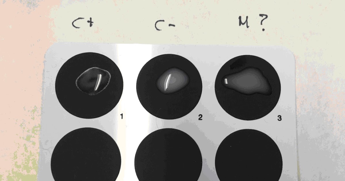 Mi laboratorio de Inmunología: FACTOR REUMATOIDE