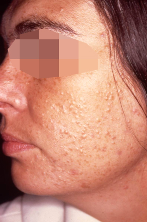 916SKIN - ACNE SKIN & WELLNESS CLINIC: TREATING GRADE 2 ACNE...