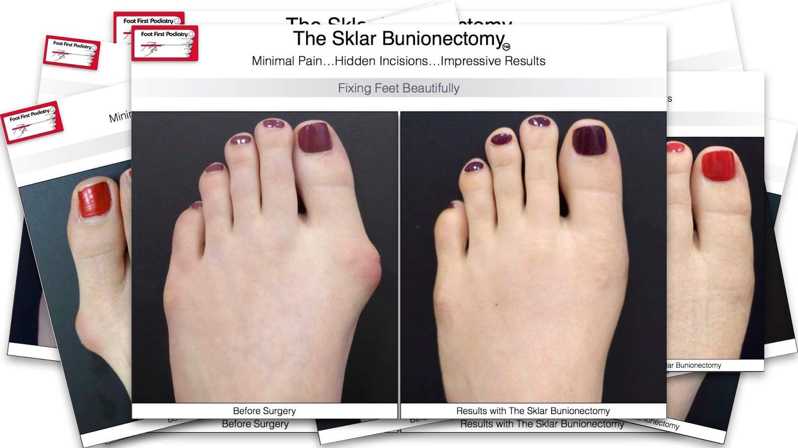 The Sklar Bunionectomy. NO casts, NO crutches and NO visible scars 💫 ...