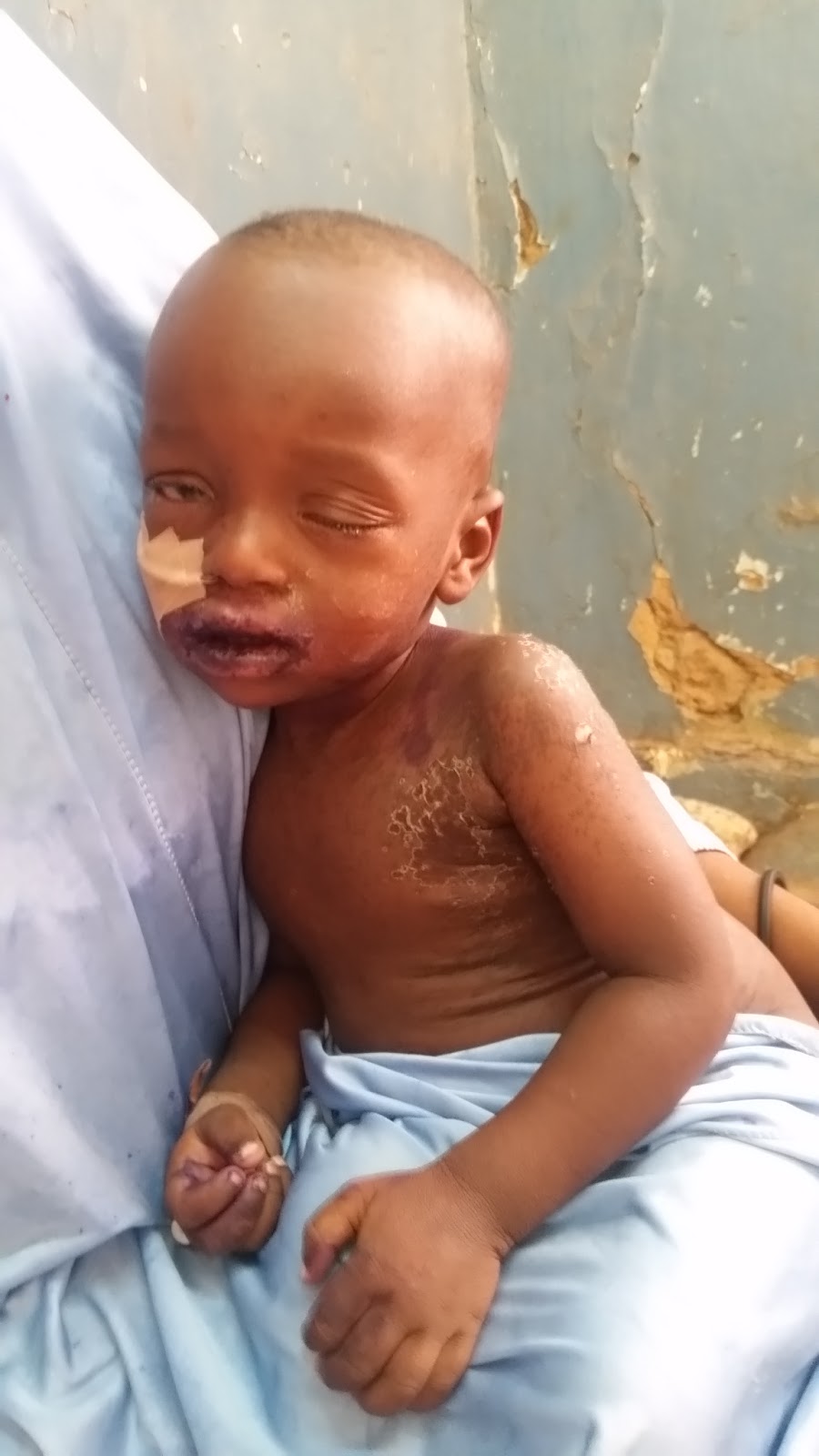 OviattsOnTheGo: Rubeola (Rougeole in French) - Measles!!