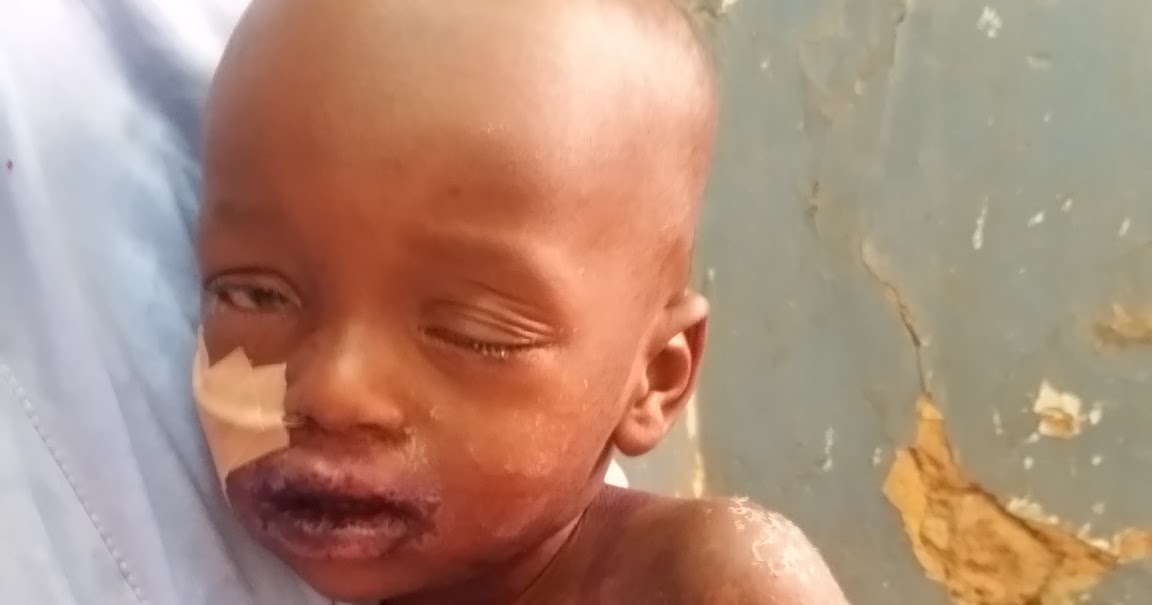 OviattsOnTheGo: Rubeola (Rougeole in French) - Measles!!