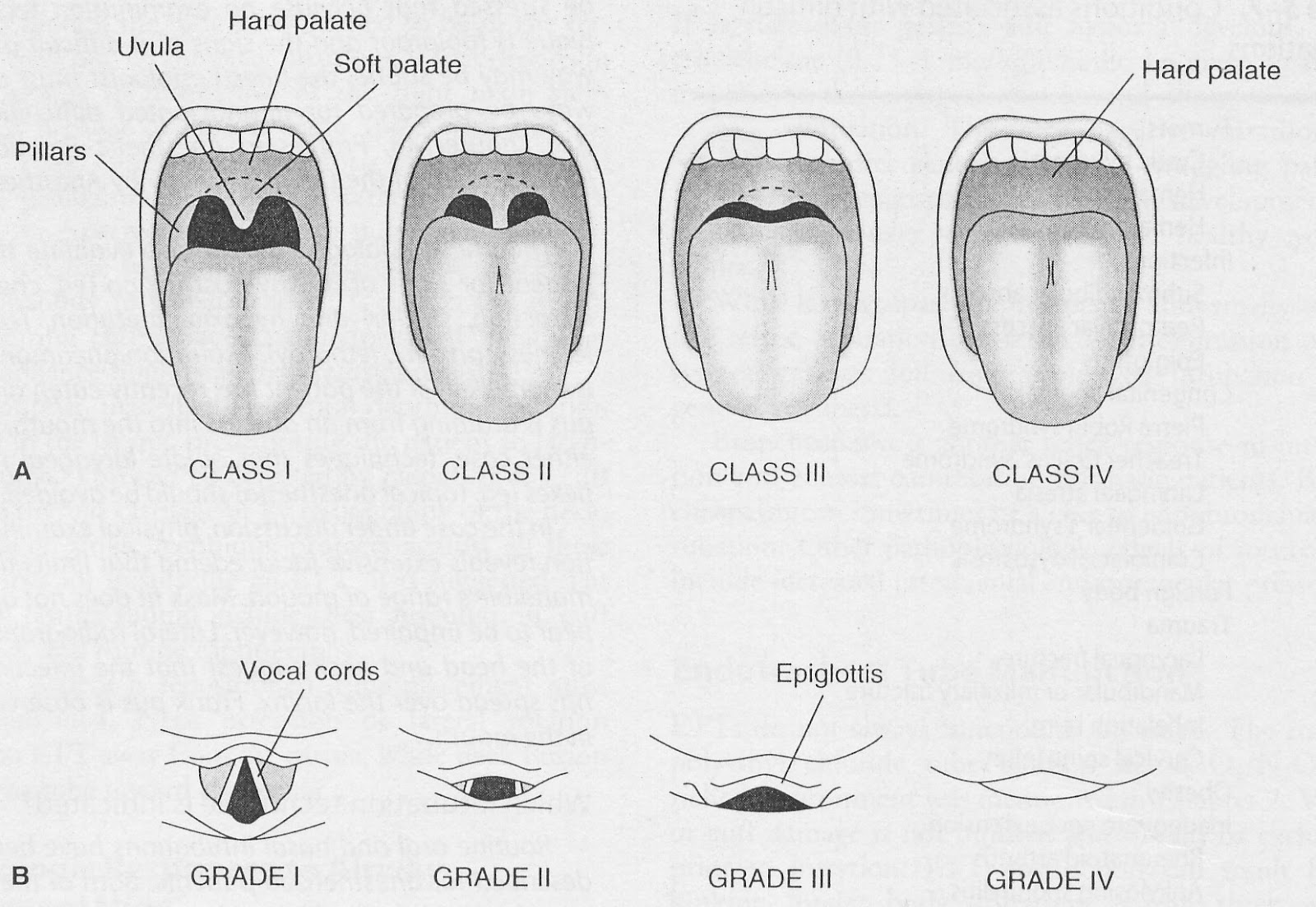 sikkahoder: INTUBASI ENDOTRAKEAL TUBE : INDIKASI, CARA MELAKUKAN ...