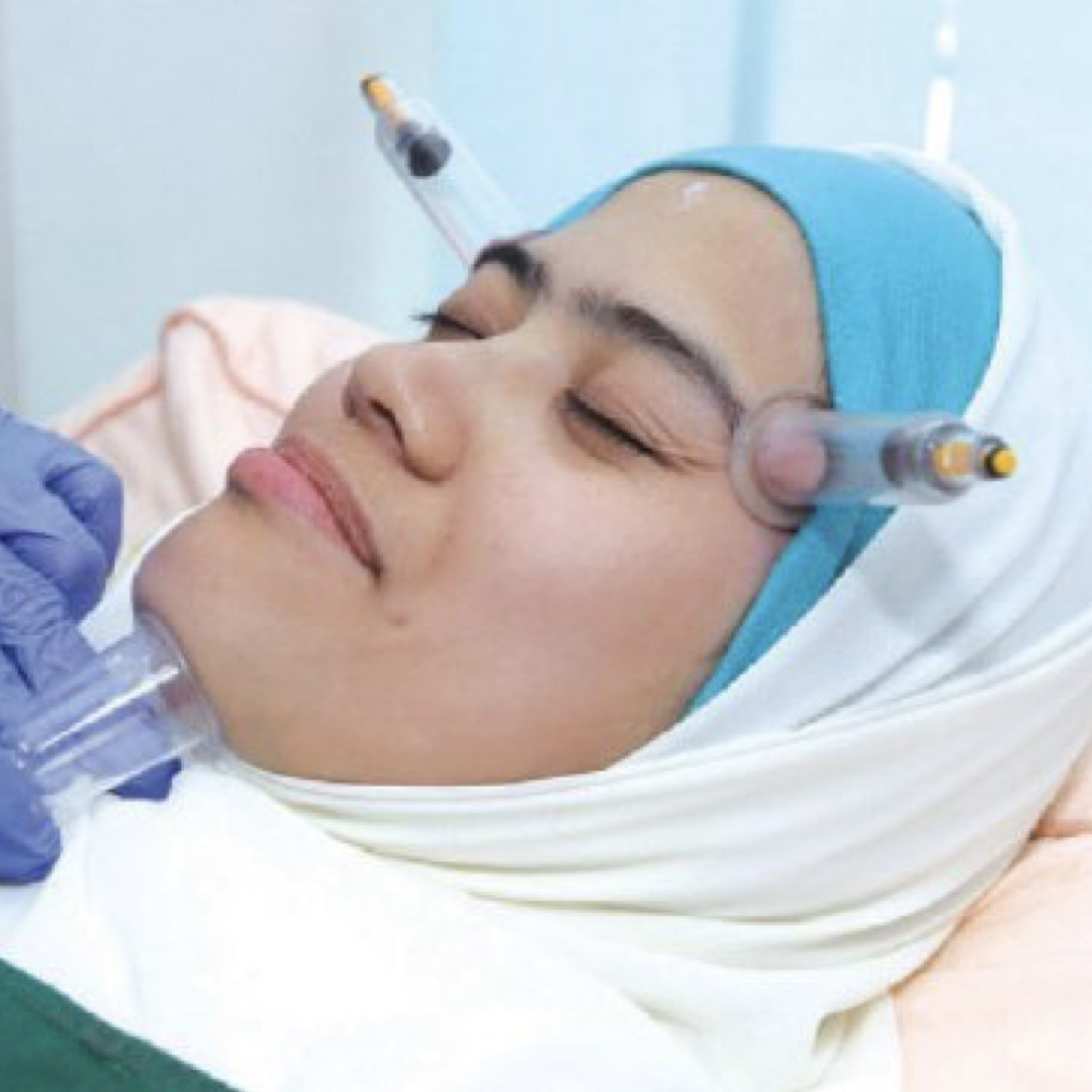 Bersihkan Saluran Darah Pada Wajah Dengan Berbekam