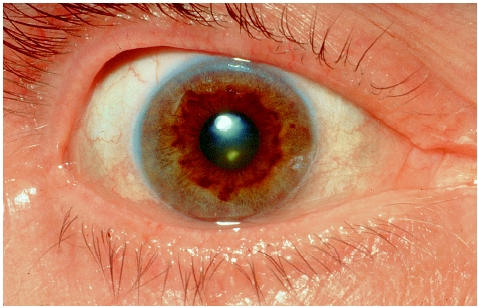 Images For Kayser Fleischer (KF) Ring - Wilson's Disease ~ YOUNG ...