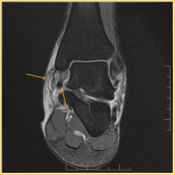Deltoid Ligament Disruption : MRI - Sumer's Radiology Blog