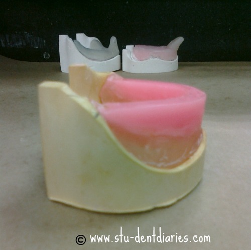 Stu-DENT Diaries: Custom Tray, Record Base and Wax Rim