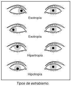 estrabismo: Estrabismo
