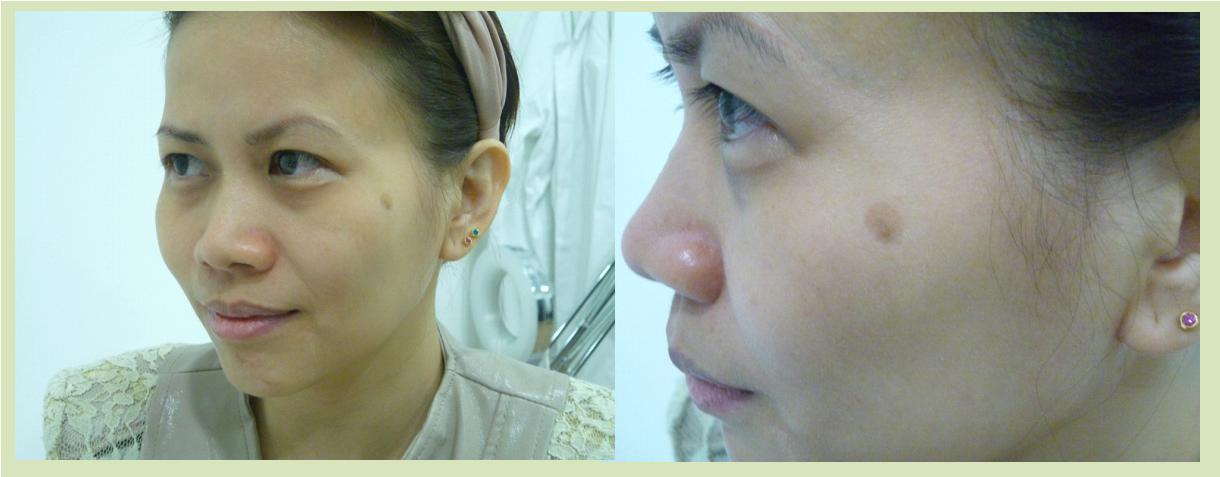 EVERGREEN LOVE: Clique Clinic - Tranexamic Acid Injection (Scar)