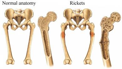 Systems of...: 8.- The Skeletal System - Diseases