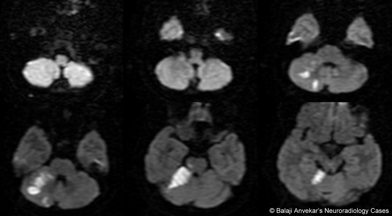 Superior Cerebellar Artery Distribution