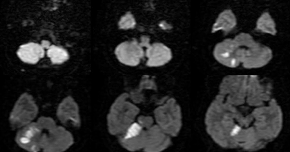 Neuroradiology Cases: Superior cerebellar territory infarct