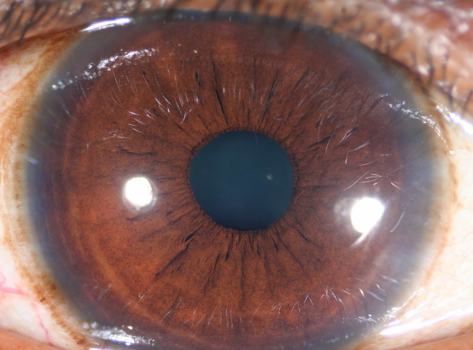 Modern & Multidimensional Iridology: IPB Morphologies, Pupil Flattening ...