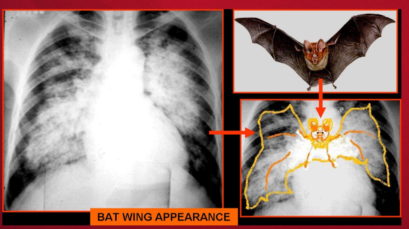 Phimaimedicine: Pulmonary edema