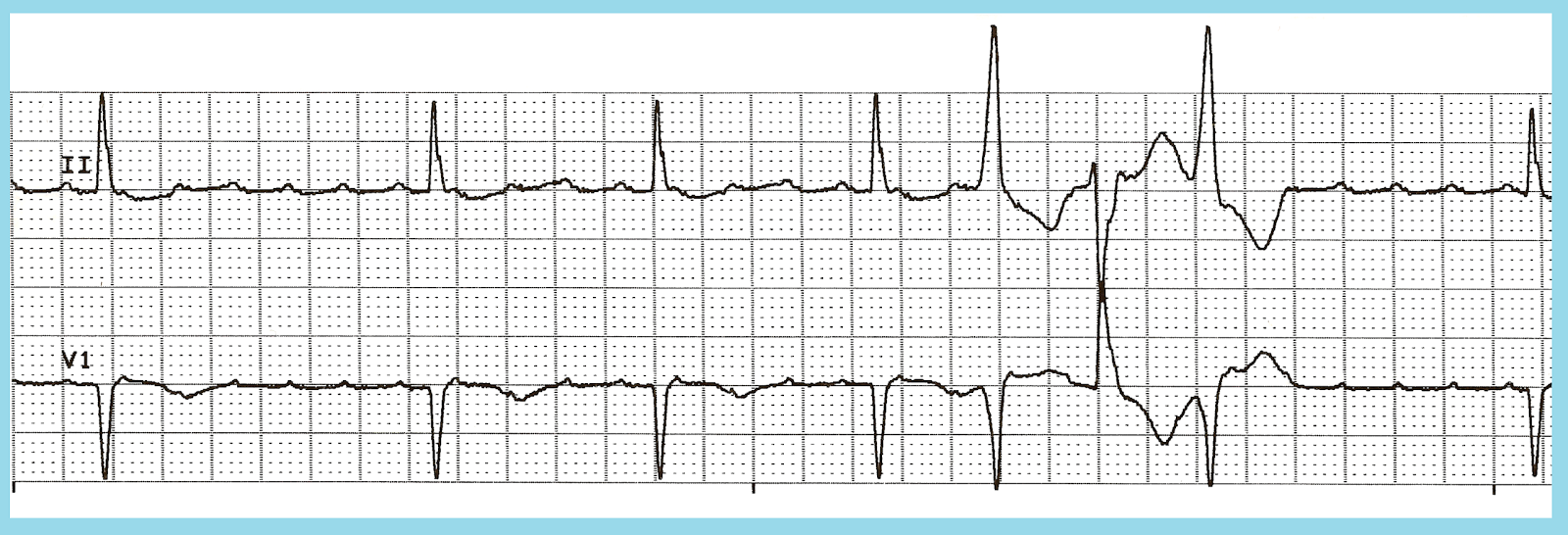 Practice Rhythm Strips 263
