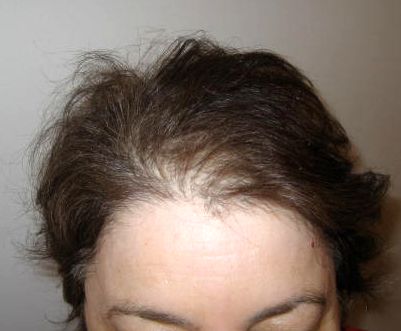 female hair loss is a very common occurrence but may not receive enough ...