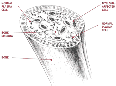 Bone Cancer - Sign and Symptoms - Your Health