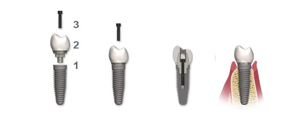 Basal implants