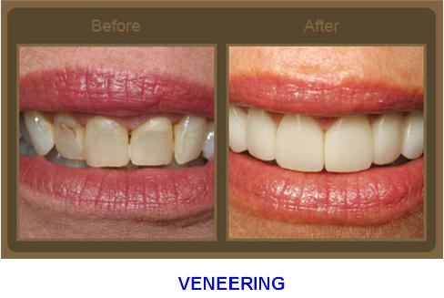Labial Veneer untuk Estetik Gigi