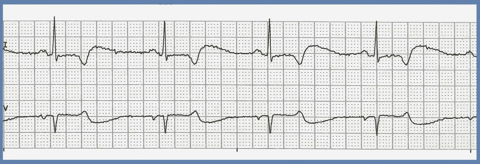 Practice Rhythm Strips 265