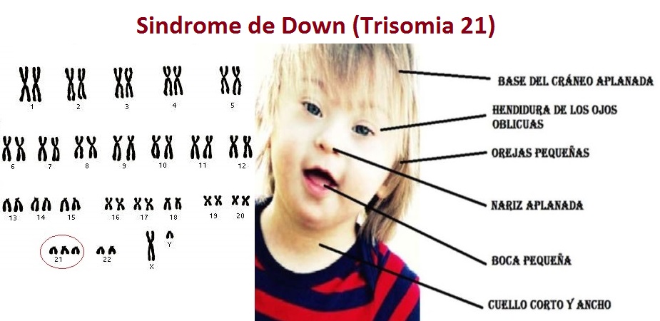Sindrome de trisomia - workmsa