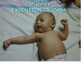 REFLEJOS DEL RECIEN NACIDO ~ Fisioterapia