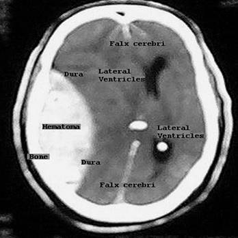 Head Trauma - radiology health