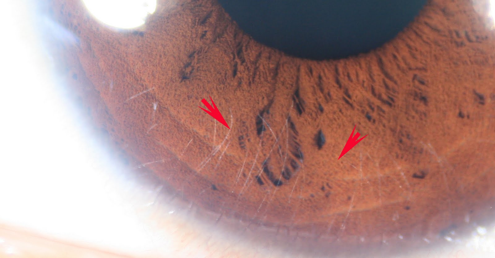 Modern & Multidimensional Iridology: Interception of the Contraction ...
