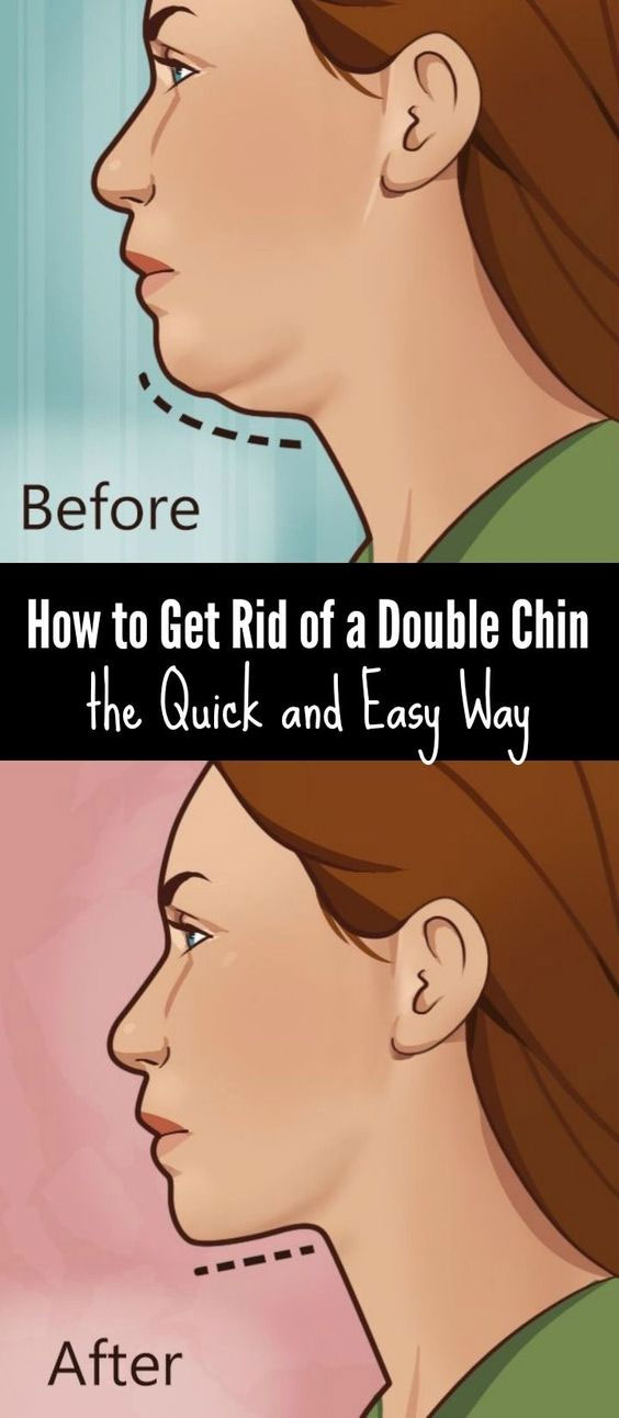 Get rid of double chin the fast and easy way - Theraphy 2