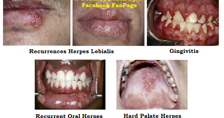 :: World Of Dentistry ::: Oral Herpes Simplex