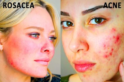 Differences Between Acne and Rosacea - NikiHow