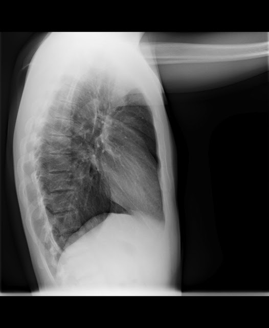 RADIOLOGIA LLEIDA: RADIOGRAFIA DE TORAX (I): Introducción, densidades y ...