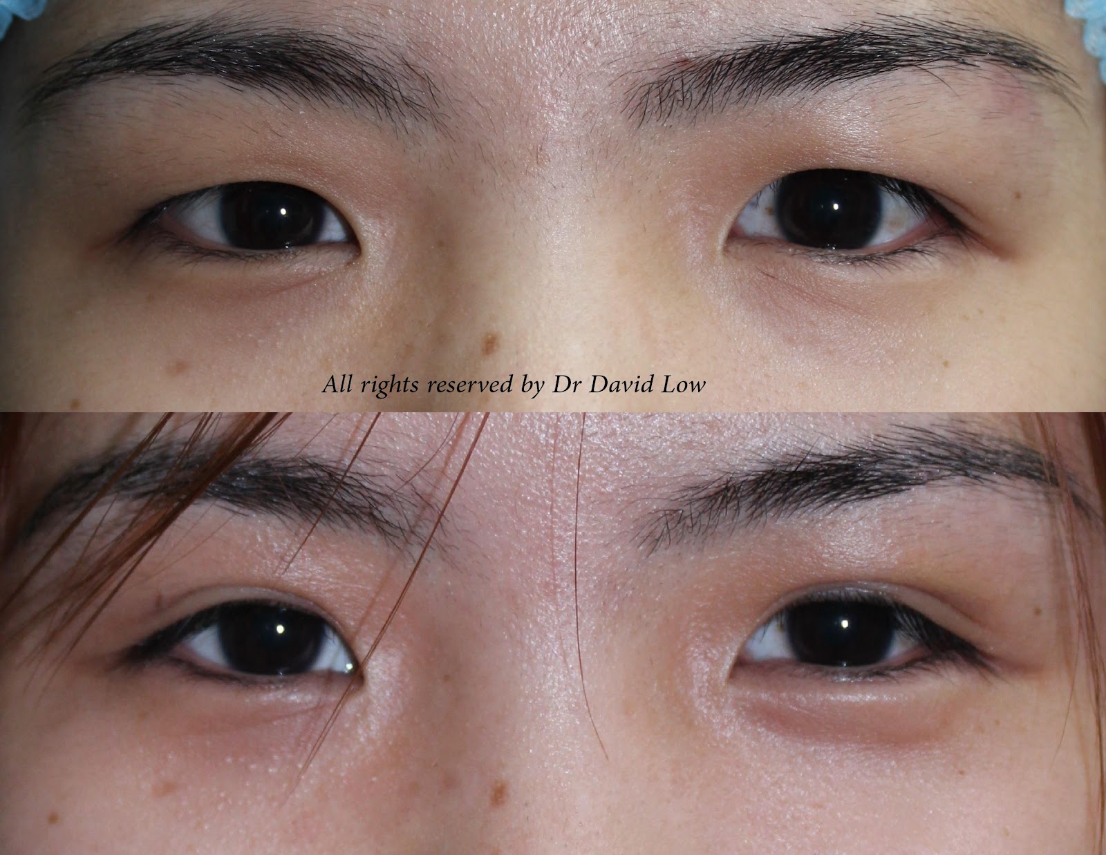 The Art & Science of Beauty : Double Eyelid Surgery