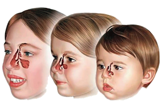 Vita Clínica Médica: RINOSSINUSITE