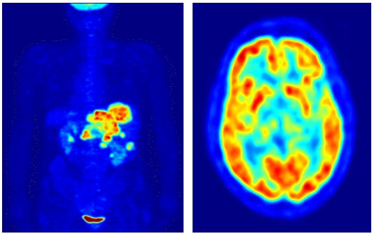 Semoga Bermanfaat: Positron Emission Tomography (PET)-SCAN
