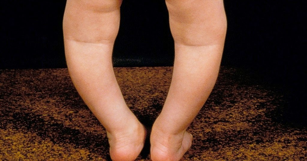 Amadurecendo Com Saúde: Criança com a perna torta preocupa?