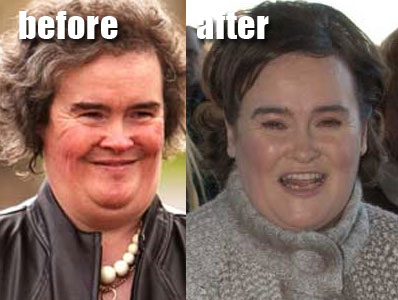 Susan Boyle Plastic Surgery Before and After Facelift and Chin Implants