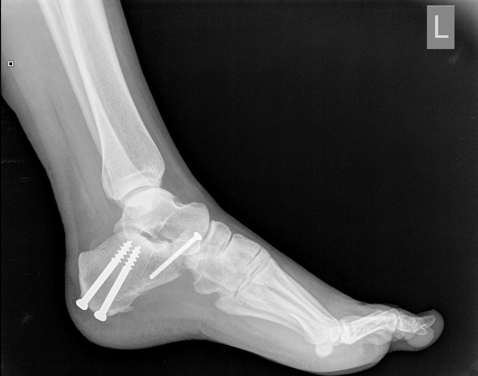 My posterior tibial tendon surgery journey: 2 week check up April 12, 2011