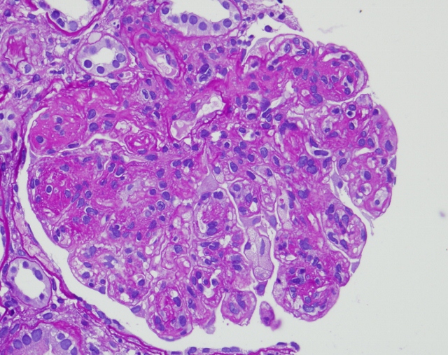 Renal Pathology Review: C3 glomerulopathy