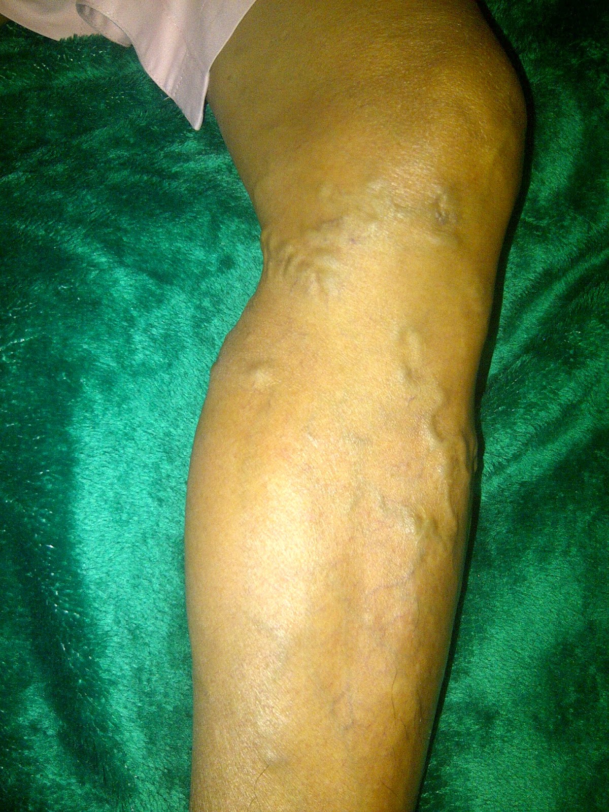 FISIOTERAPI MUDA: varises vena