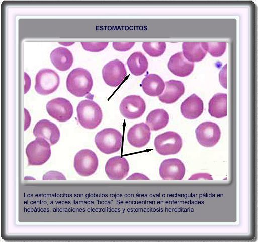 Células Sanguíneas y su patología.: CelulasSanguineasyPatologias