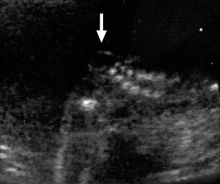 ABC Radiology Blog: The Lemon Sign