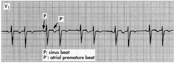 ER goldbook: EKG interpretation